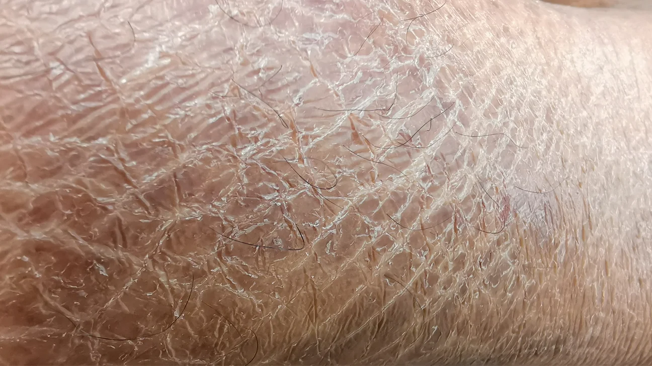 心安學堂：惱人冬季癢-缺脂性皮膚炎(Xerotic dermatitis, Asteatotic dermatitis)